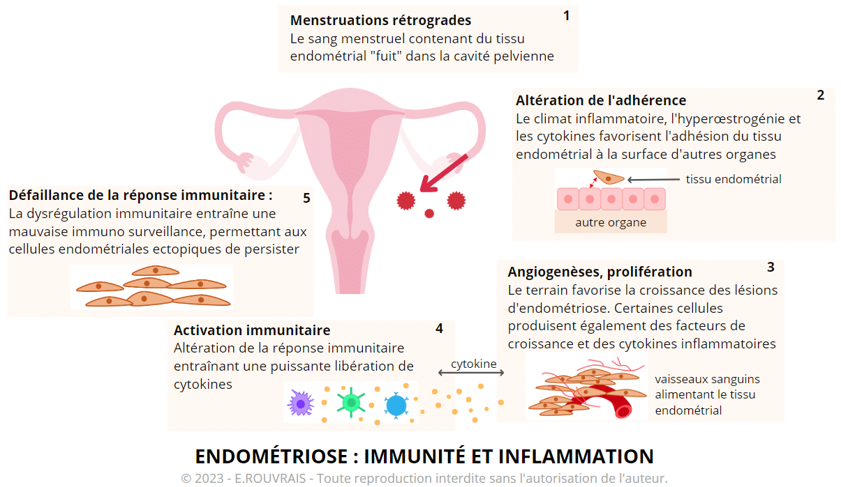 Endométriose : comprendre cette maladie gynécologique chronique